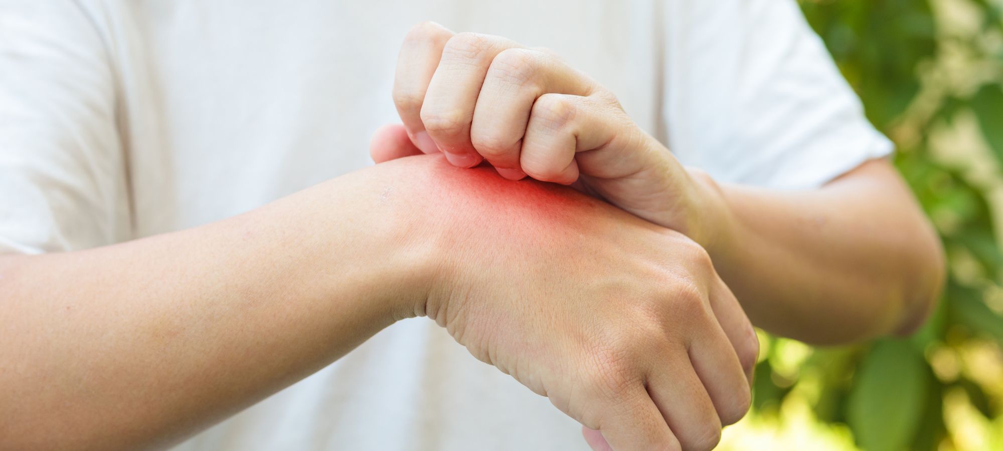 Infected Insect Bites Treatment in Chelsea - Chelsea Green Pharmacy